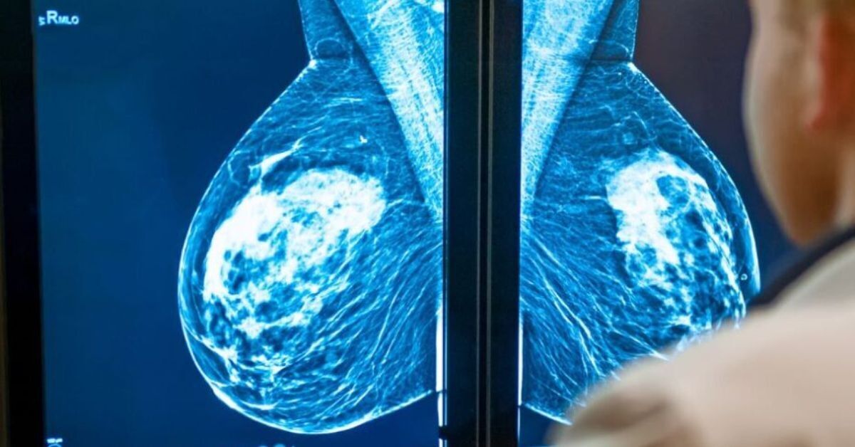 Understanding Mammograms: A Vital Tool in Breast Health - MyPressportal ...